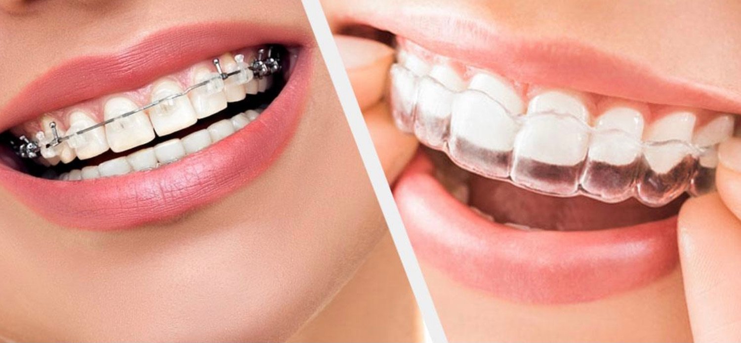 Braces in Karachi 2026 – Types, Cost & Best Orthodontist Guide